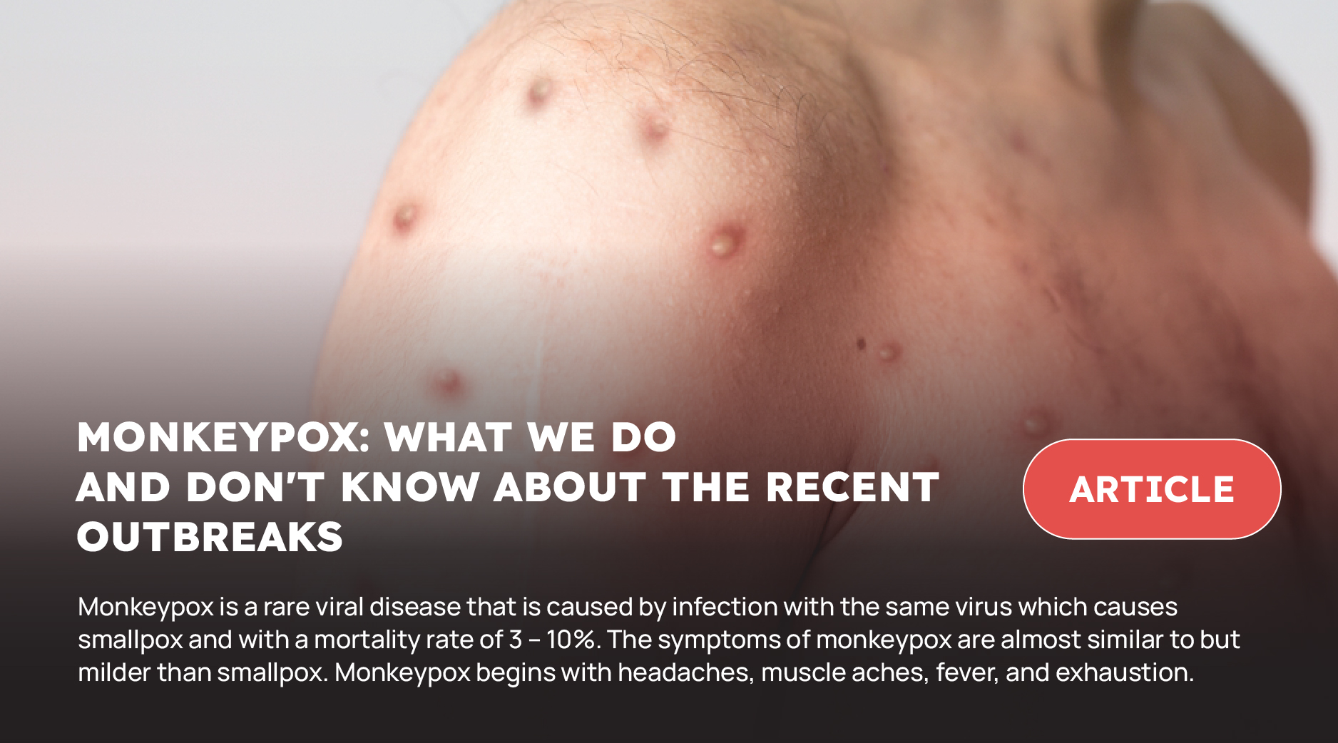 Monkeypox: What We Do and Don't Know About the Recent Outbreaks - Docquity